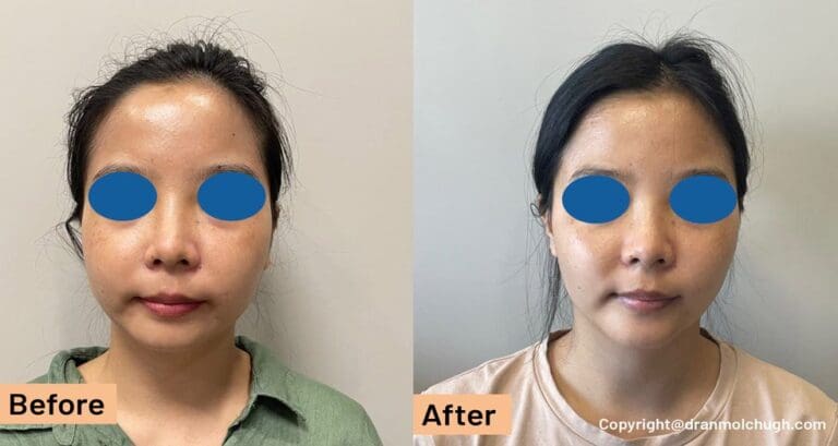 Chin Implant Surgery in Gurgaon, Chin Augmentation Surgeon Delhi NCR India
