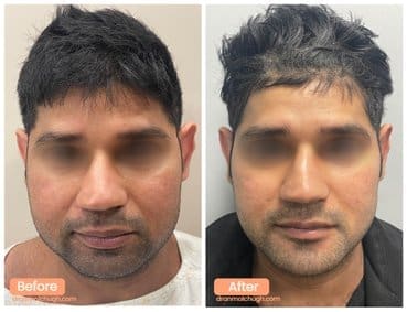 Chin Implant Surgery in Gurgaon, Chin Augmentation Surgeon Delhi NCR India