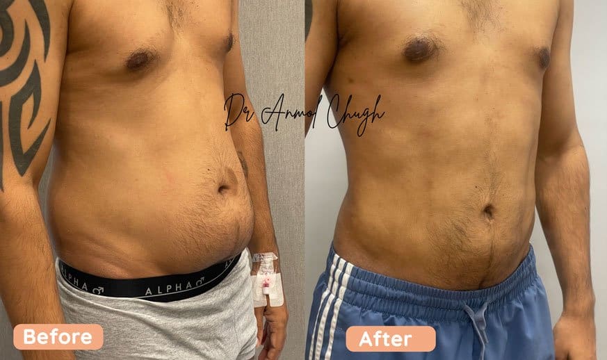 Best Liposuction Surgeon in Gurgaon, Delhi | Fat Removal Surgery Cost ...