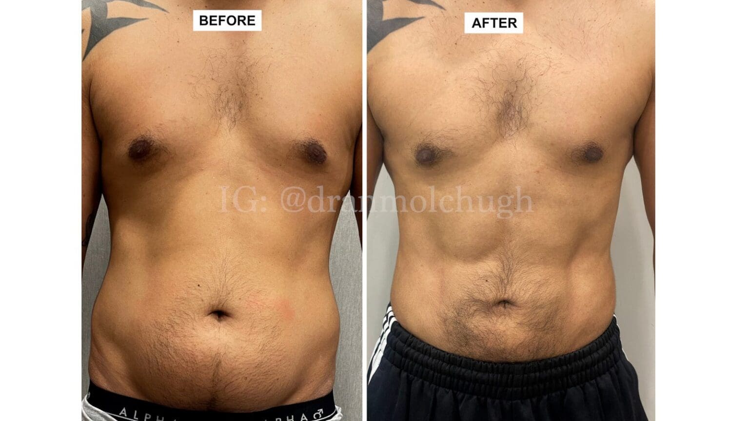 Best Liposuction Surgeon in Gurgaon, Delhi | Fat Removal Surgery Cost ...